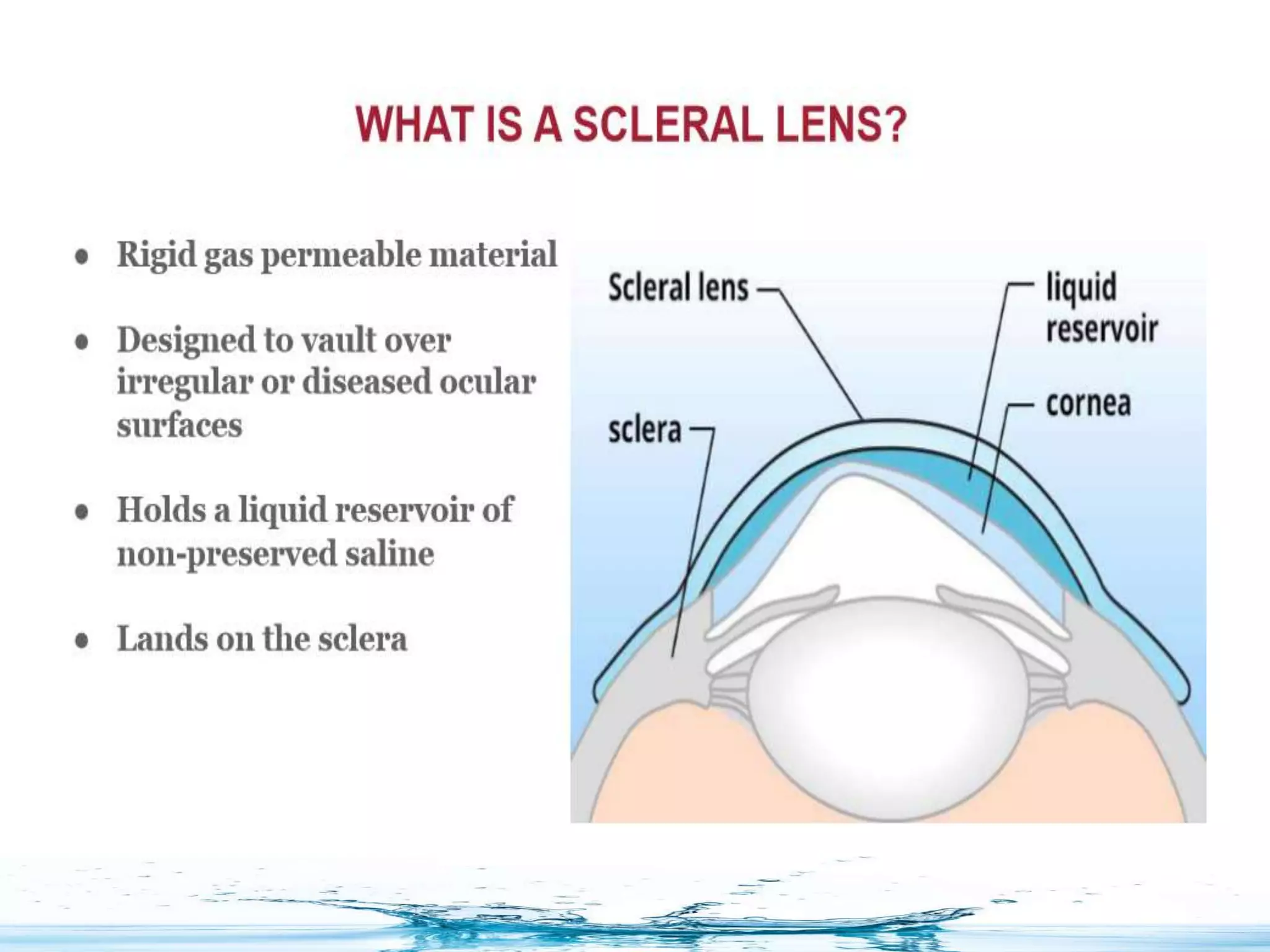 Scleral contact lenses | PPTX