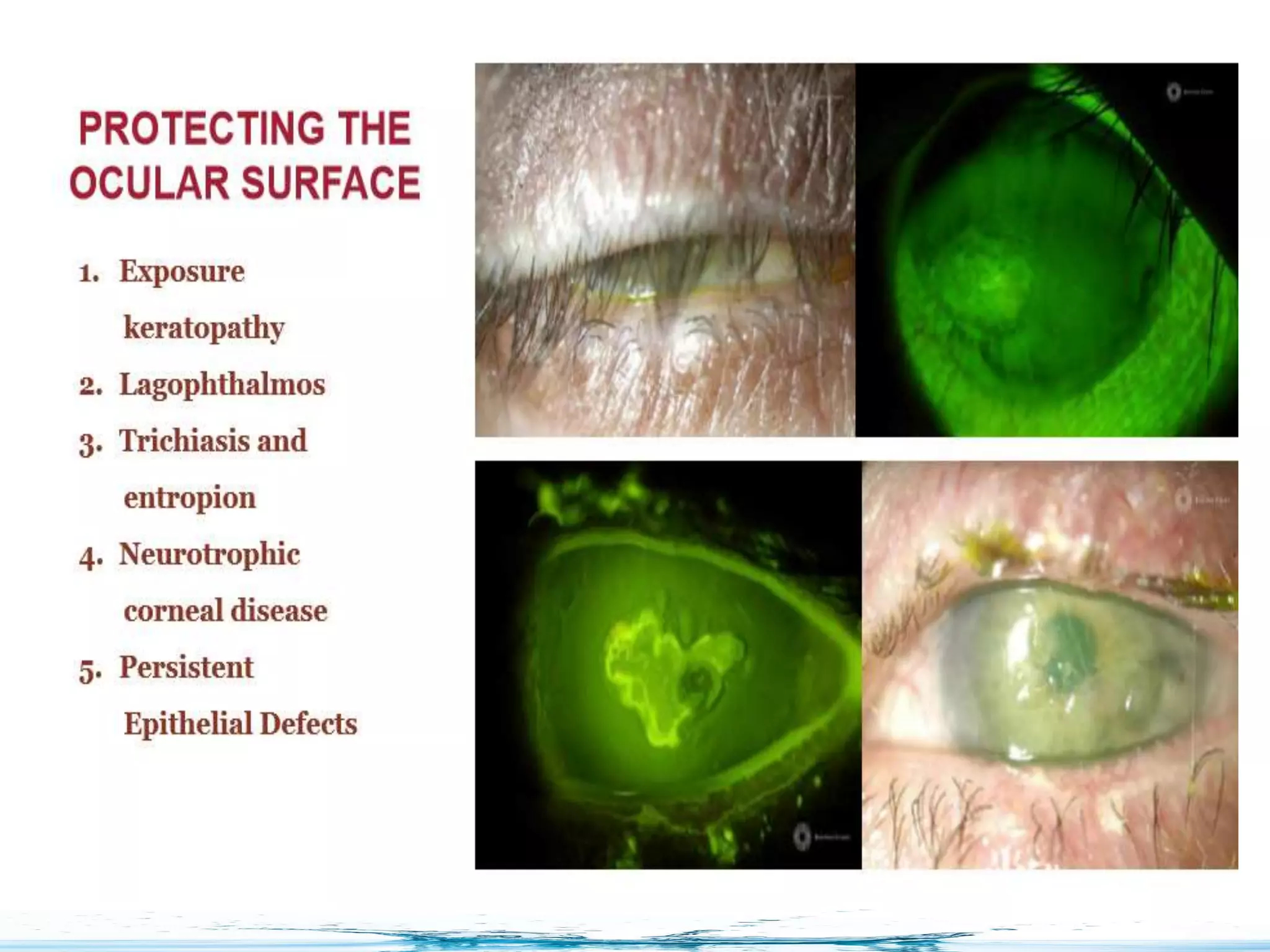 Scleral contact lenses | PPTX