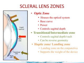 Scleral contact lenses | PPTX