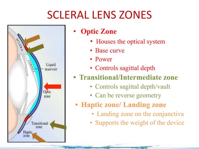 Scleral contact lenses | PPTX