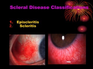 Sclera lecture by dr abdul basir safi | PDF