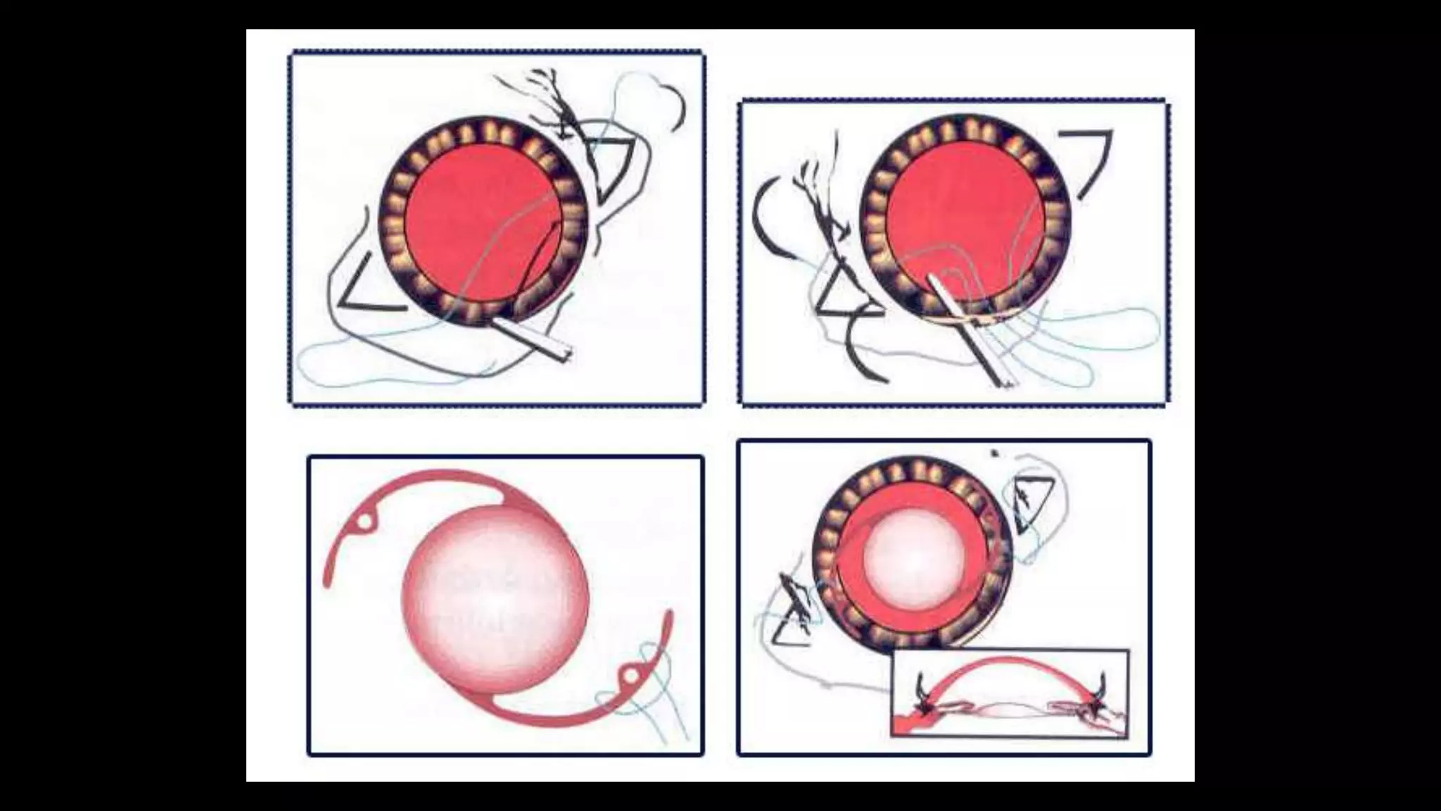 Scleral fixation technique | PPTX