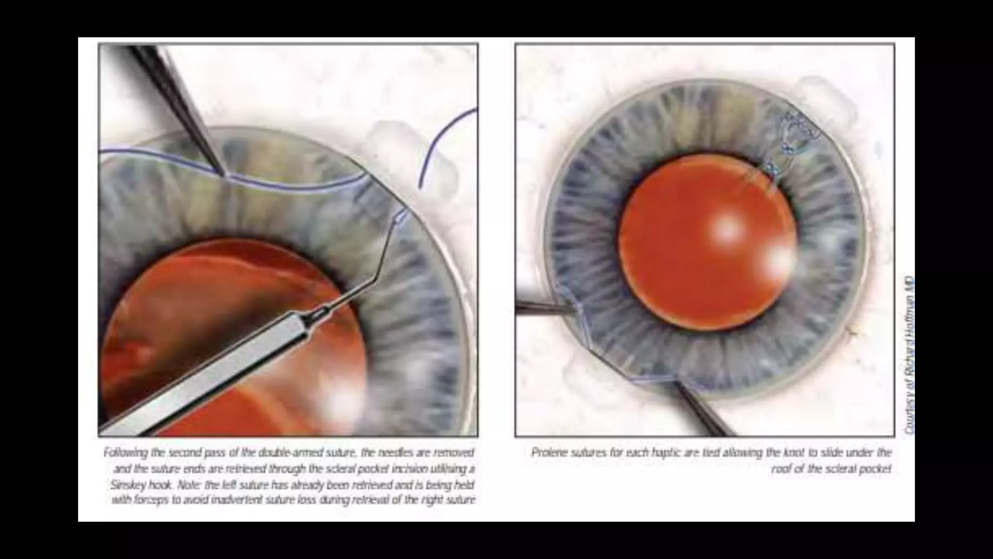 Scleral fixation technique | PPTX