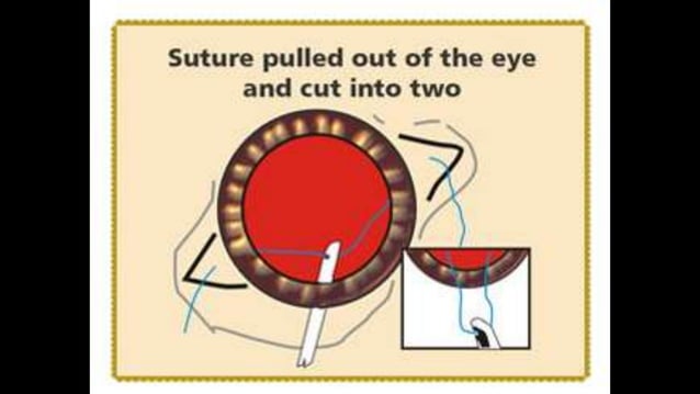 Scleral fixation technique | PPTX
