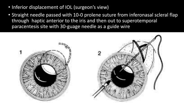 Scleral fixation technique | PPTX
