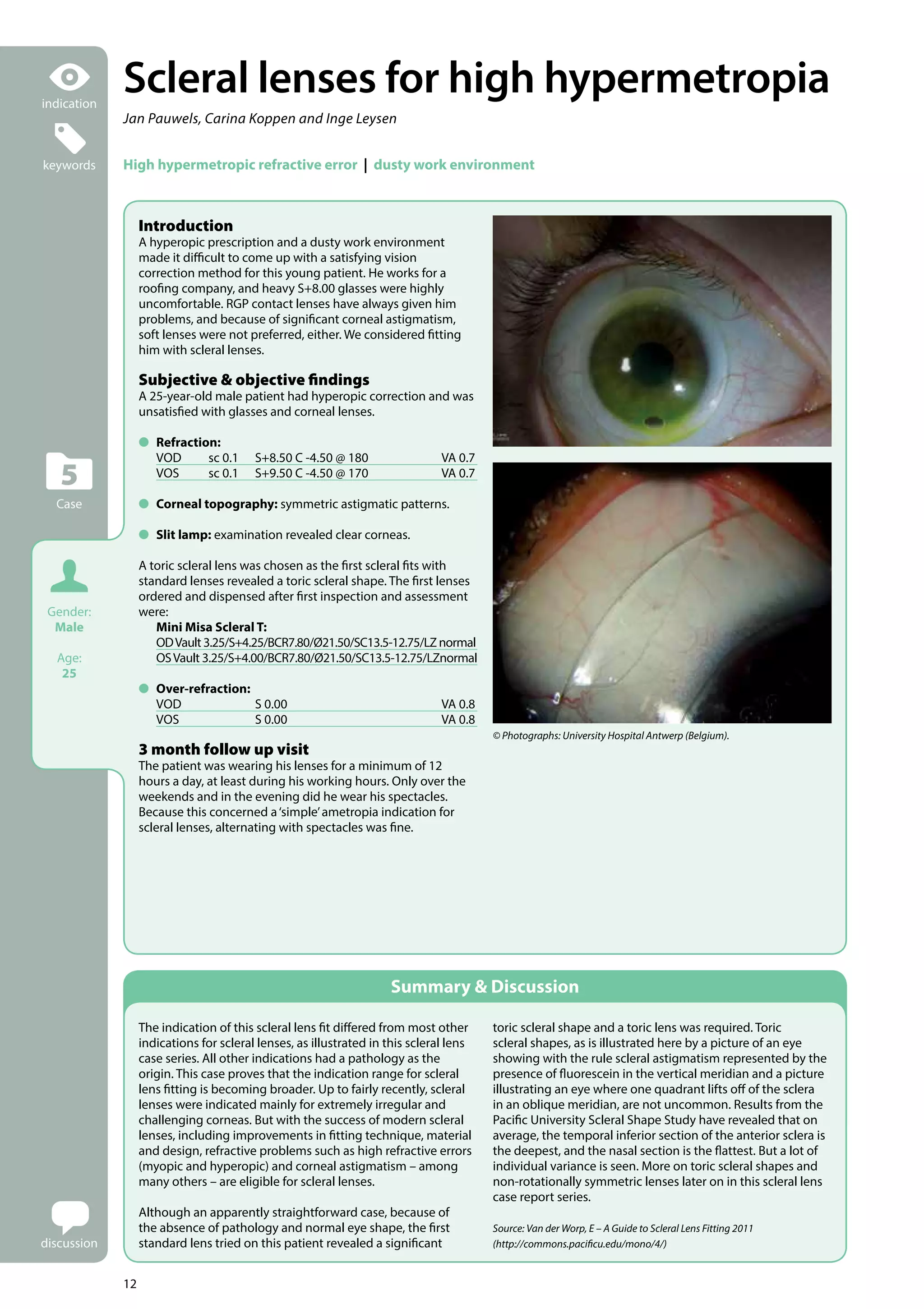 Scleral lens case report series beyond the corneal borders | PDF