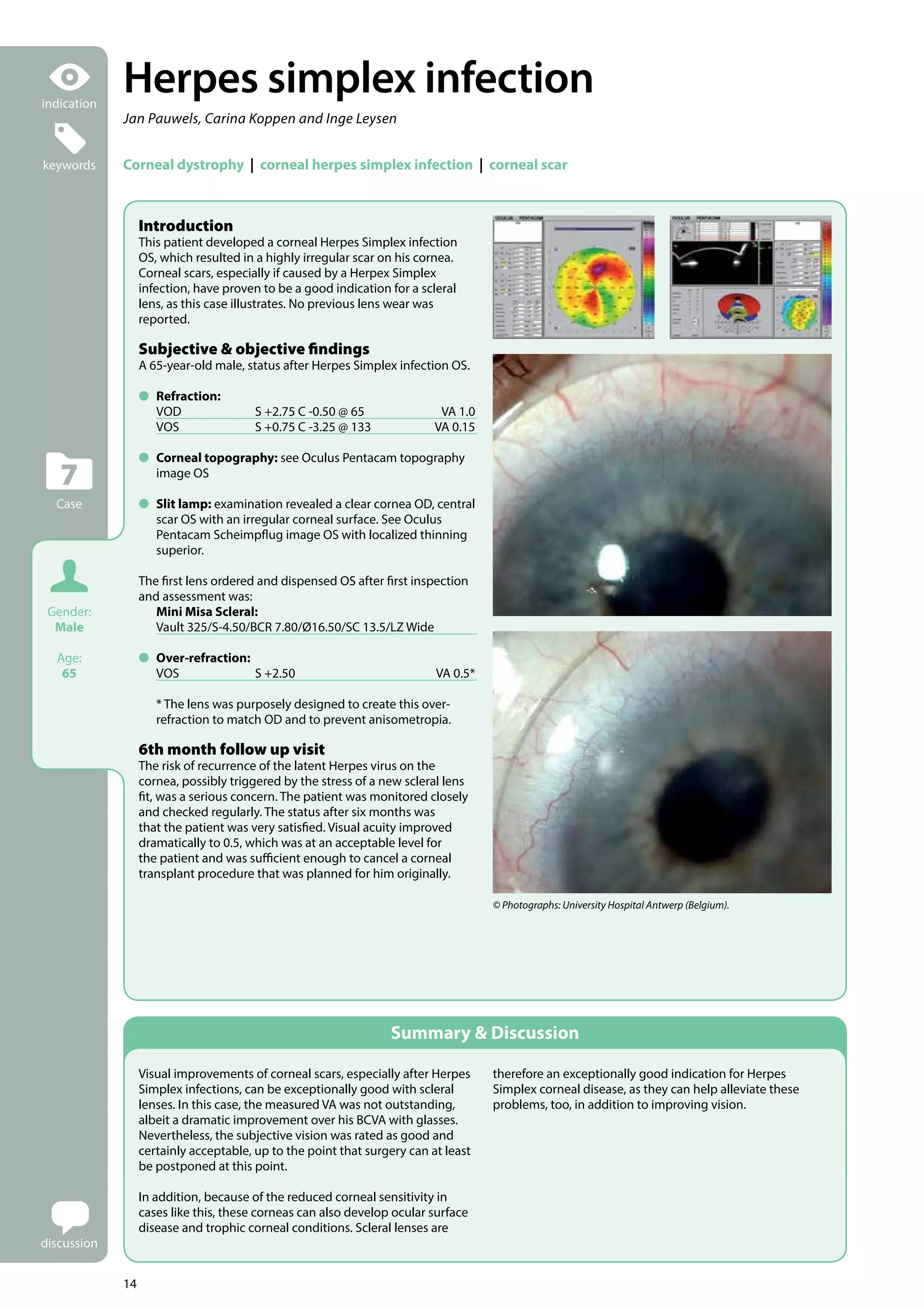 Scleral lens case report series beyond the corneal borders | PDF
