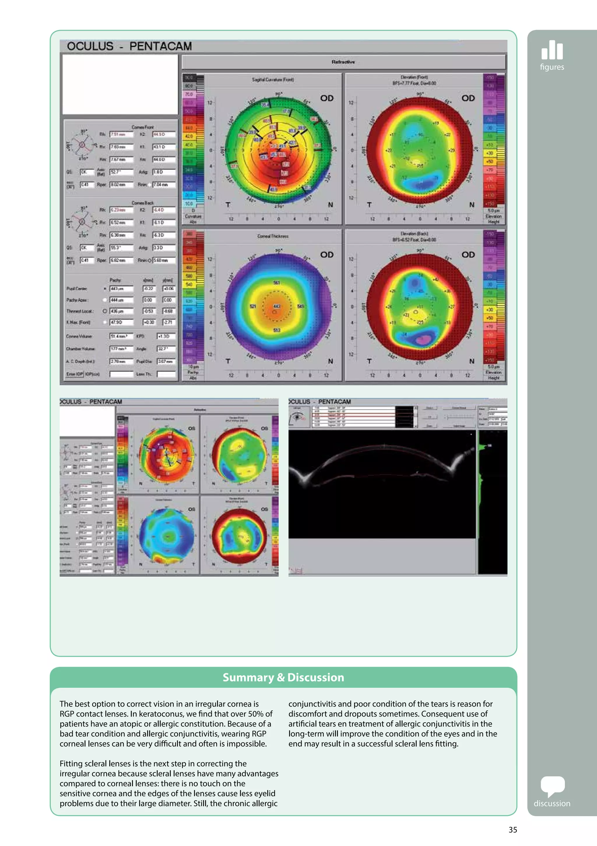 Scleral lens case report series beyond the corneal borders | PDF