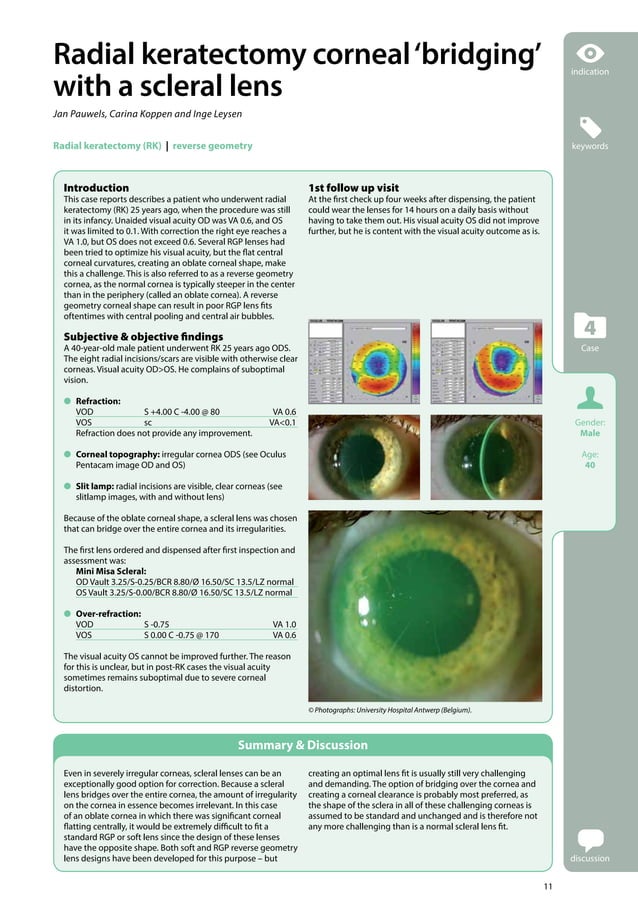 Scleral lens case report series beyond the corneal borders | PDF | Eye ...