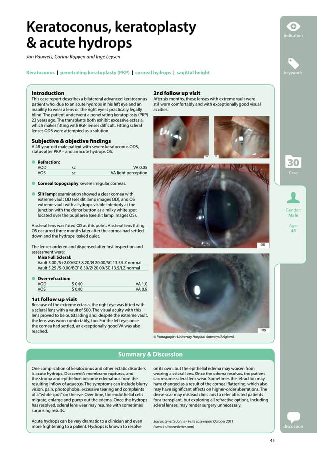 Scleral lens case report series beyond the corneal borders | PDF | Eye ...