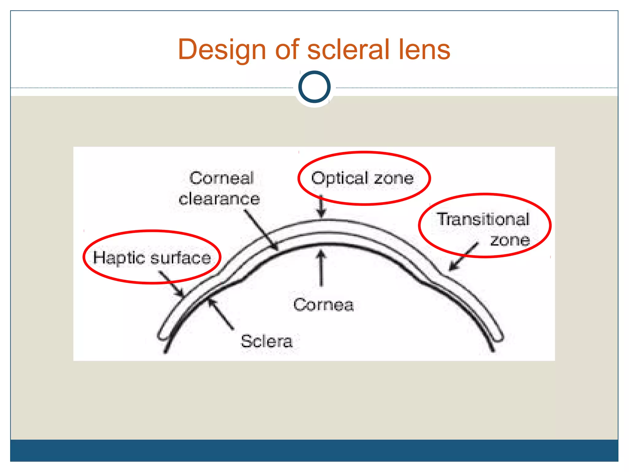 Scleral lenses | PPT