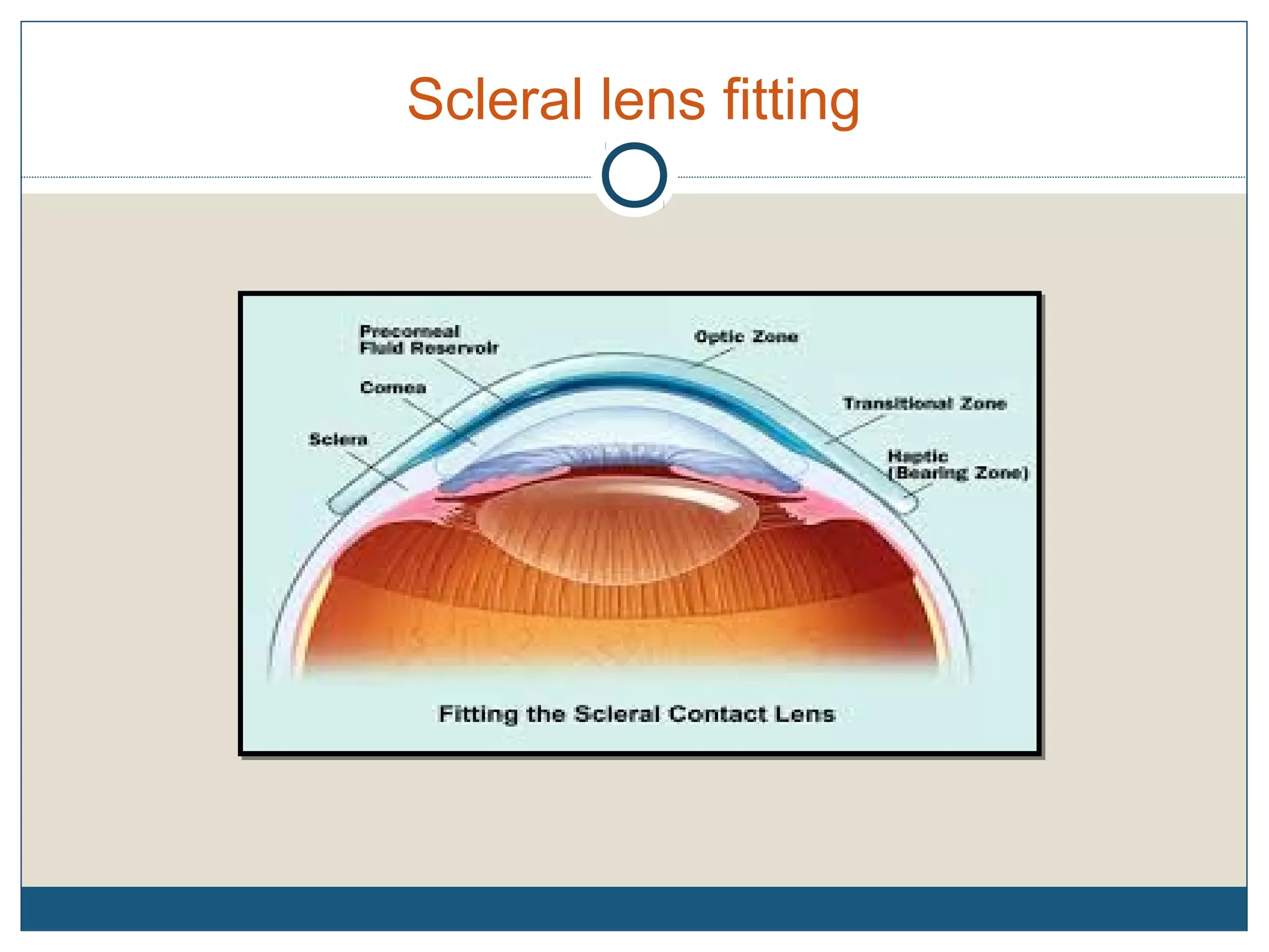 Scleral lenses | PPT