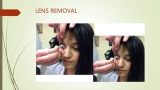 Scleral lens fitting | PPT