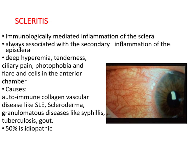 Tenon capsule ,Sclera and limbus : subash | PPTX | Eye and Vision ...
