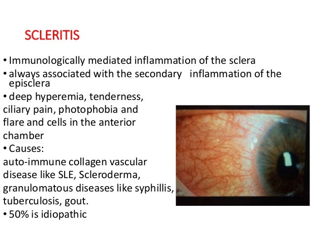 Tenon capsule ,Sclera and limbus : subash