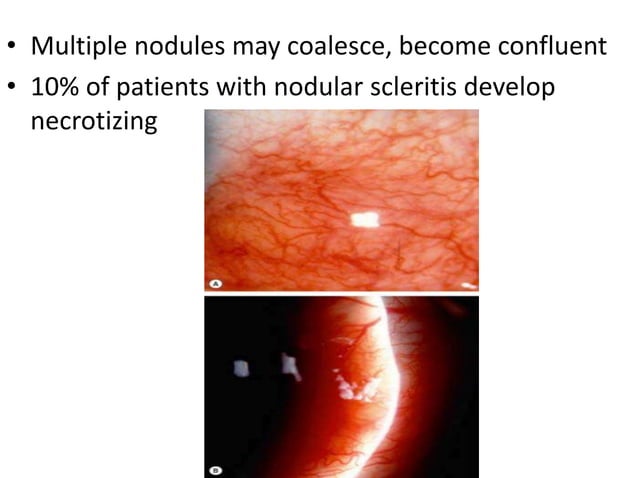 Scleritis | PPTX | Eye and Vision Conditions | Diseases and Conditions