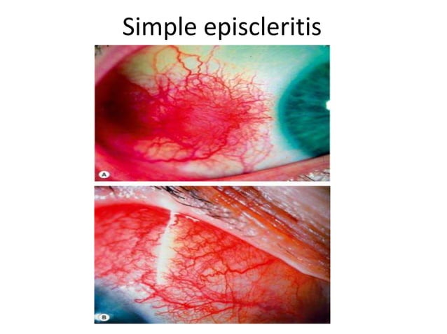Scleritis | PPTX | Eye and Vision Conditions | Diseases and Conditions
