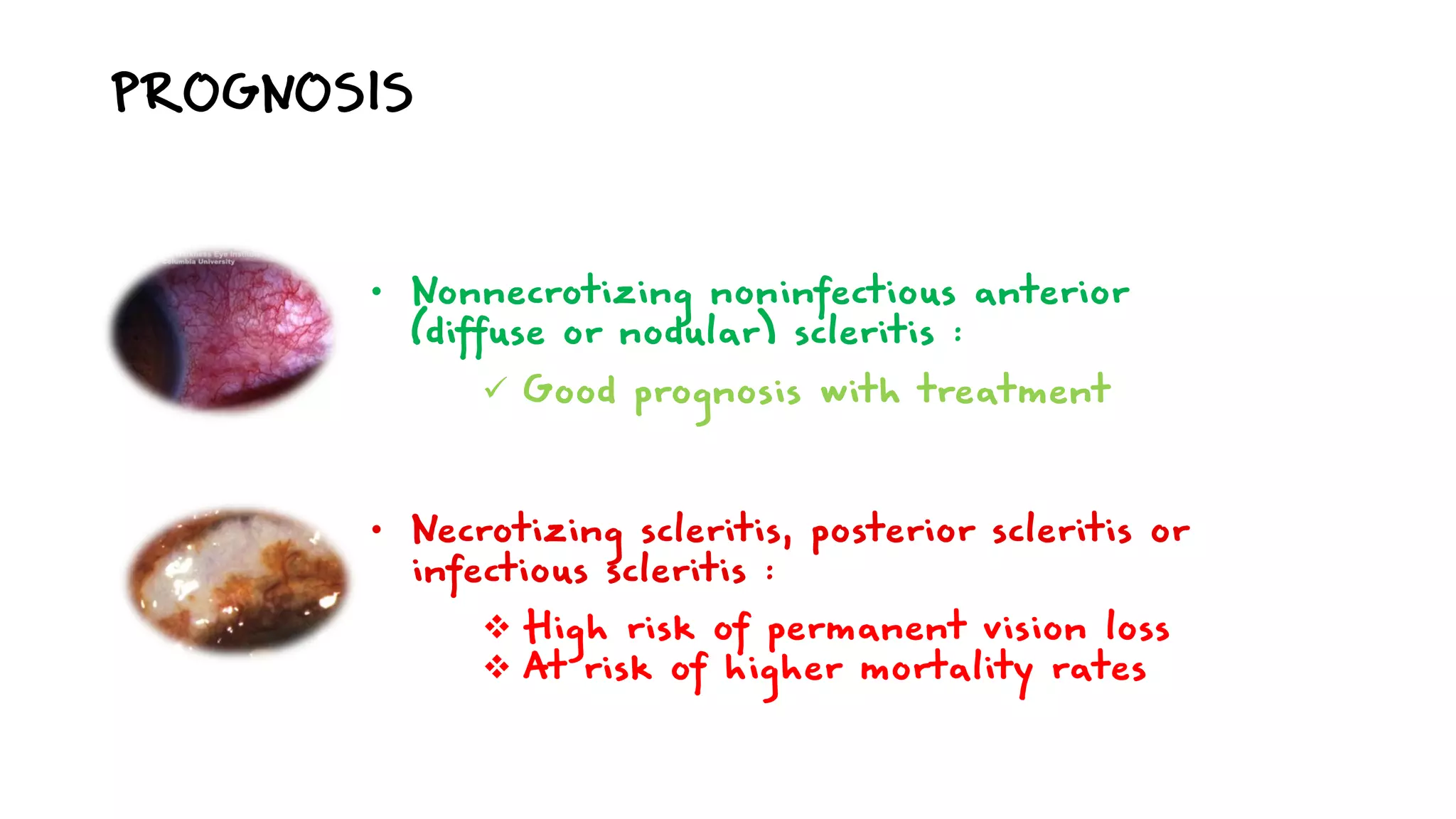 Scleritis (Inflammation of Sclera) | PPT