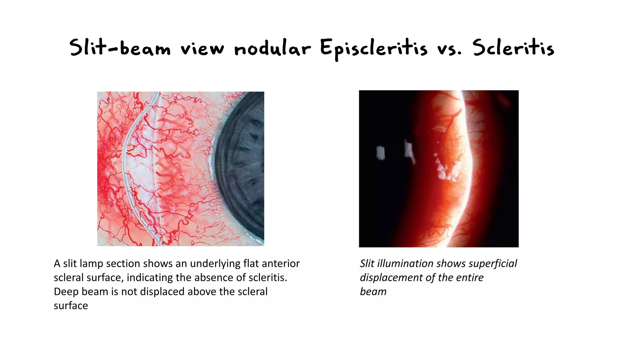Scleritis (Inflammation of Sclera) | PPT