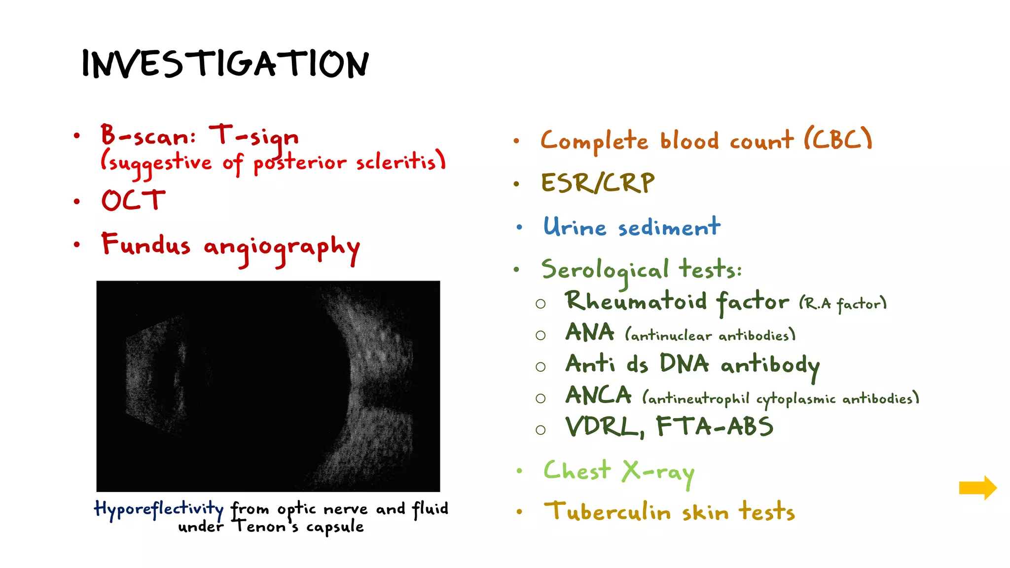 Scleritis (Inflammation of Sclera) | PPT