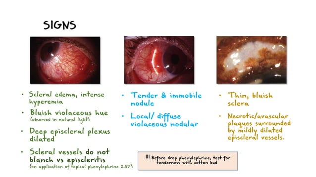 Scleritis (Inflammation of Sclera) | PPT