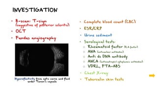 Scleritis (Inflammation of Sclera) | PDF