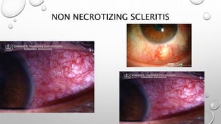 SCLERITIS.pptx
