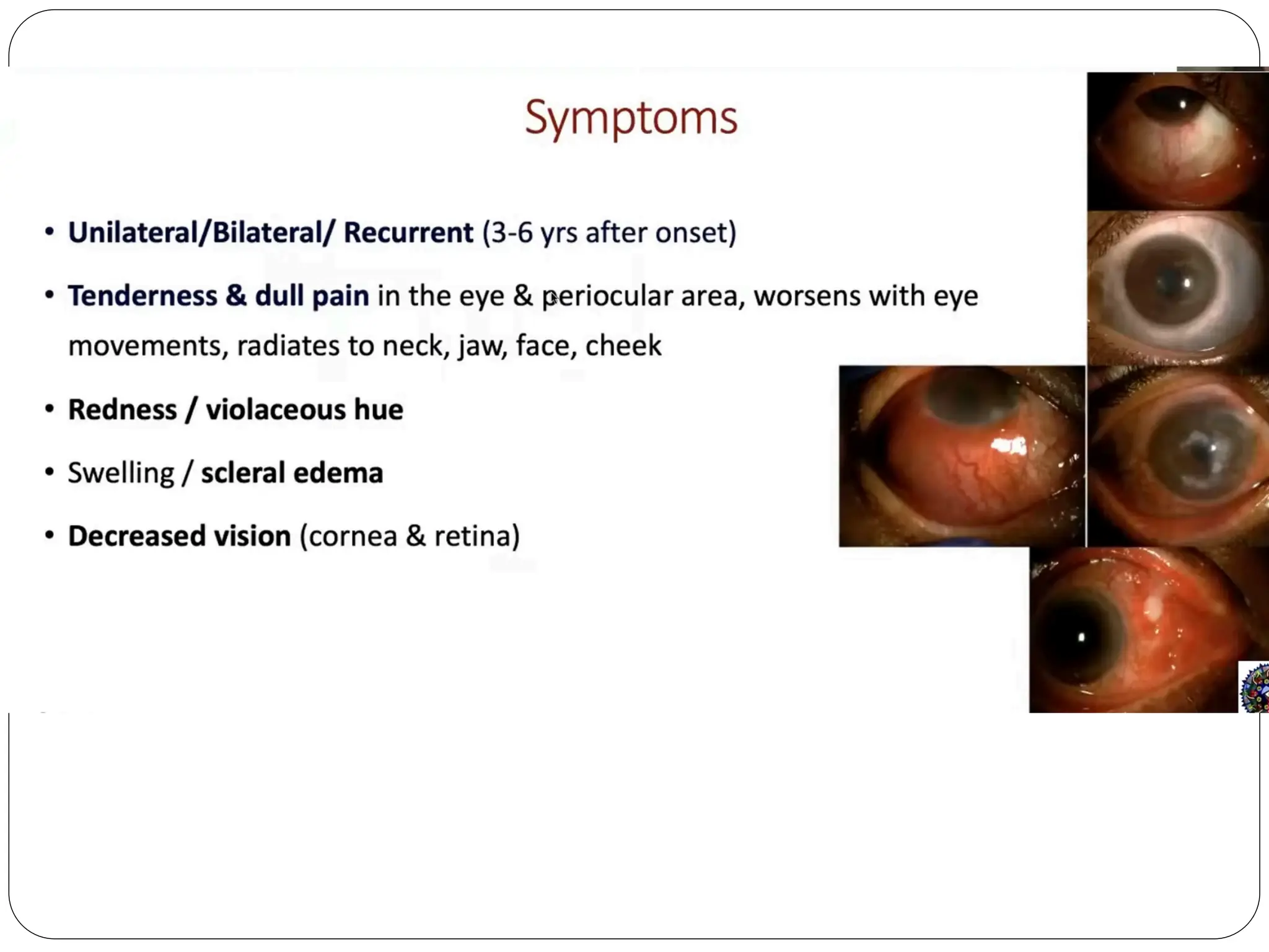 SCLERITIS- various presentations ,investigations and treatment ...