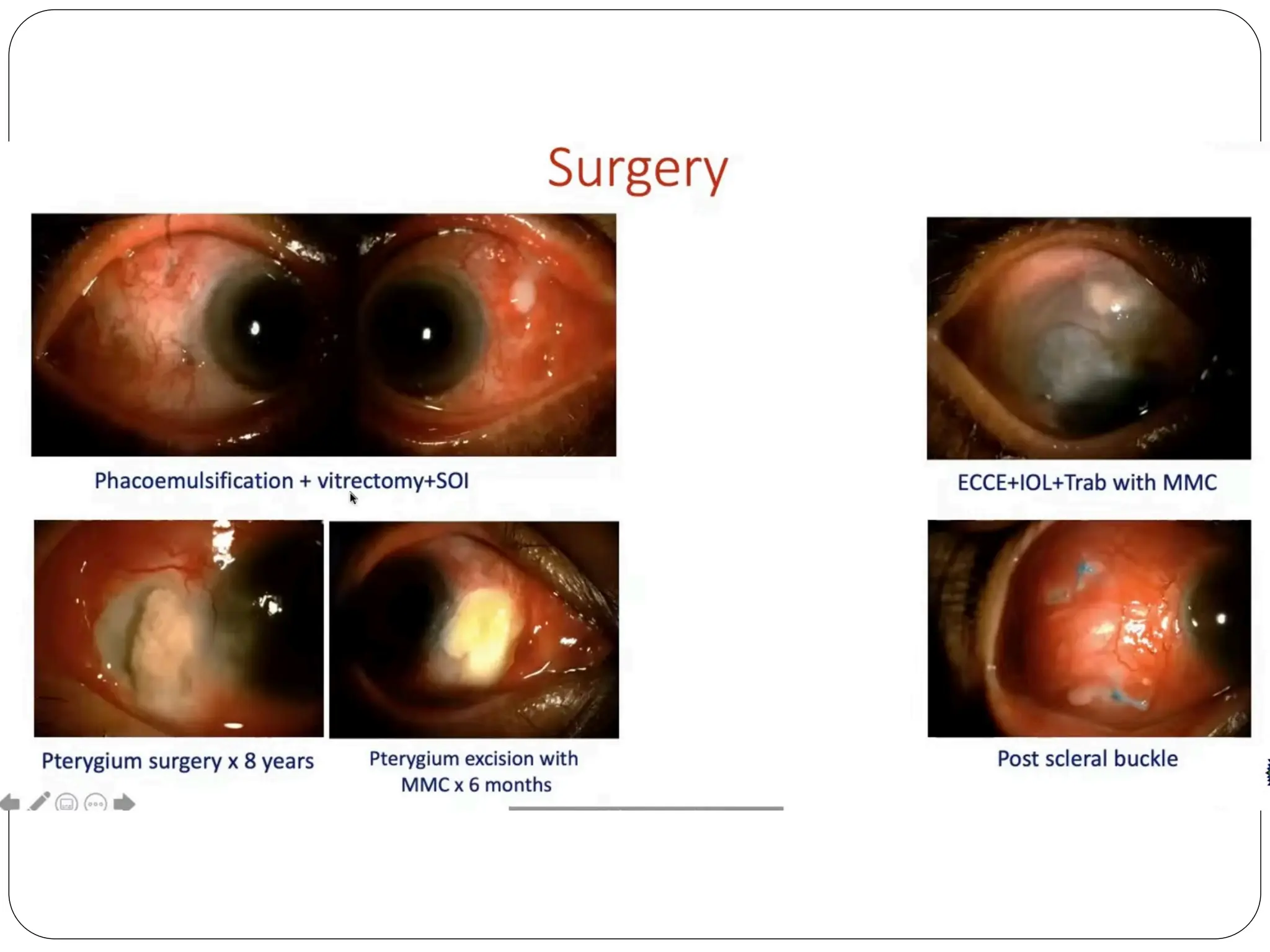 SCLERITIS- various presentations ,investigations and treatment ...