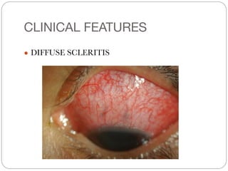 SCLERITIS- various presentations ,investigations and treatment ...