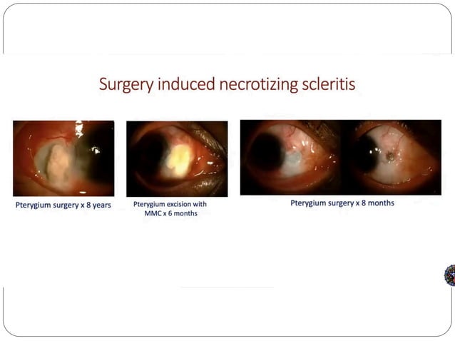 SCLERITIS- various presentations ,investigations and treatment ...