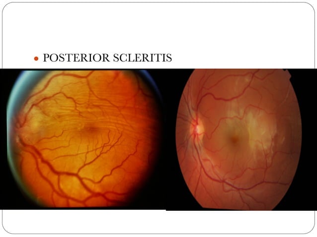 SCLERITIS- various presentations ,investigations and treatment ...