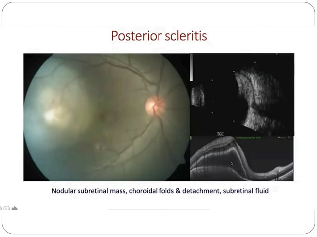 SCLERITIS- various presentations ,investigations and treatment ...