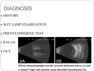 SCLERITIS- various presentations ,investigations and treatment ...