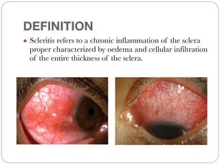 SCLERITIS- various presentations ,investigations and treatment ...