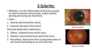 Scleritis types and treatment diagnosis. | PPTX