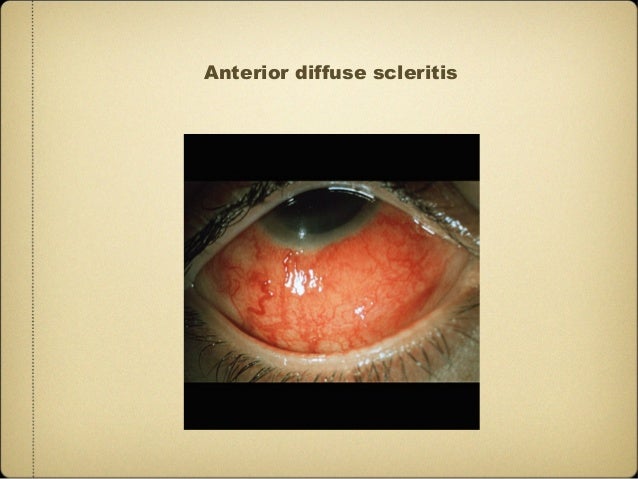 Scleritis1