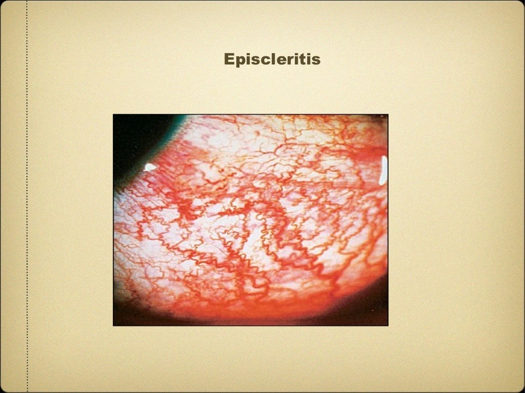 Scleritis1