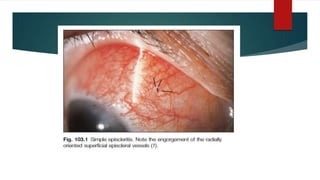 Scleritis and episcleritis | PPTX