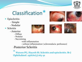 Scleritis & episcleritis | PPTX