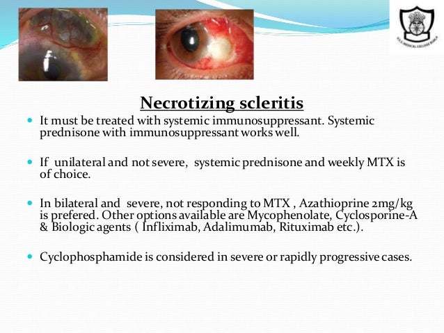 Scleritis & episcleritis