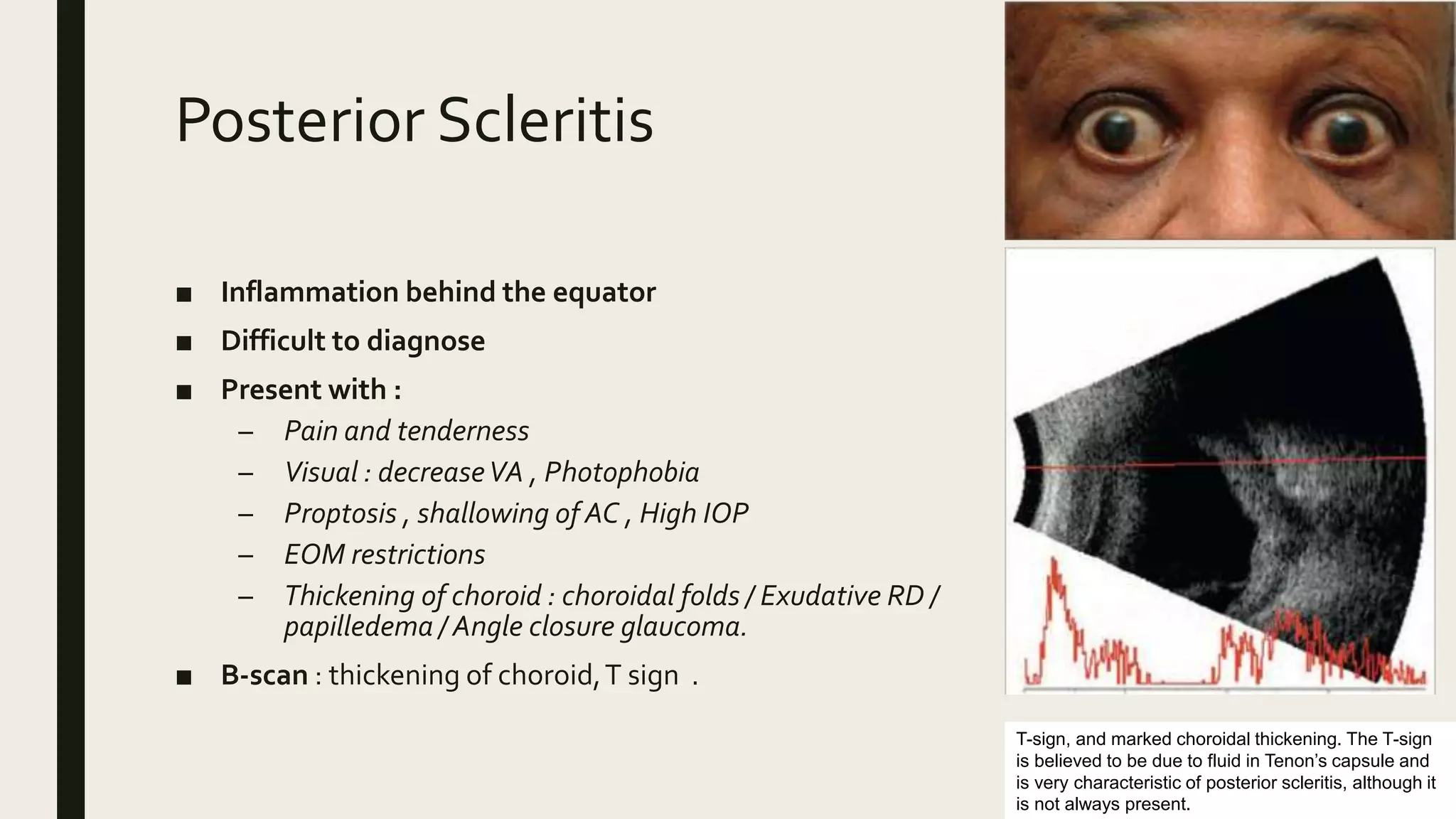 Scleritits. episcleritis | PPTX