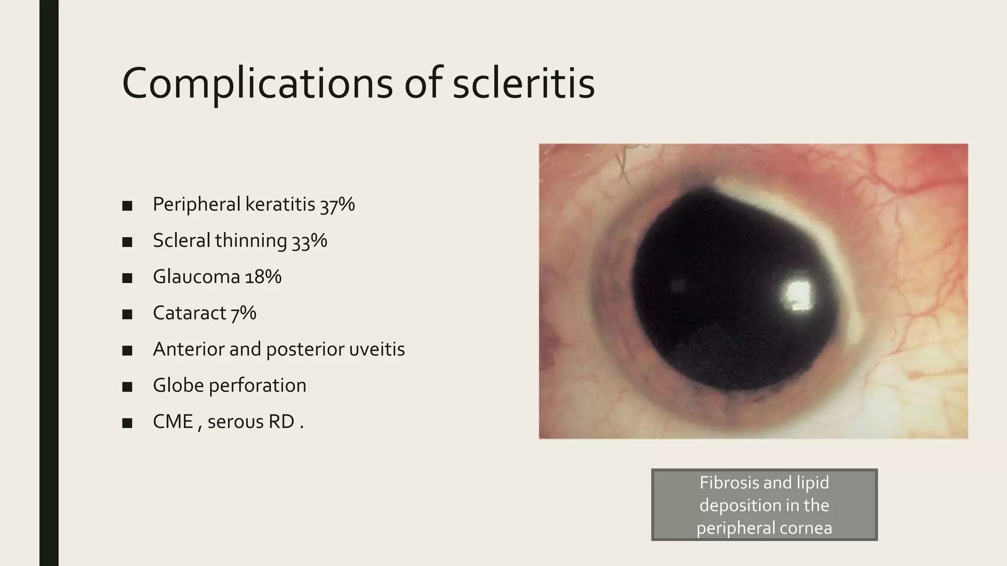 Scleritits. episcleritis | PPTX