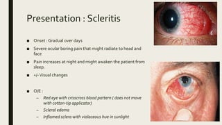 Scleritits. episcleritis | PPTX