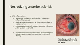 Scleritits. episcleritis | PPTX