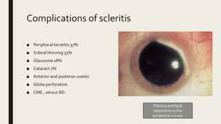 Scleritits. episcleritis | PPTX