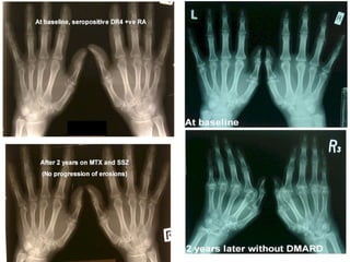 Scleroderma Hands Xray