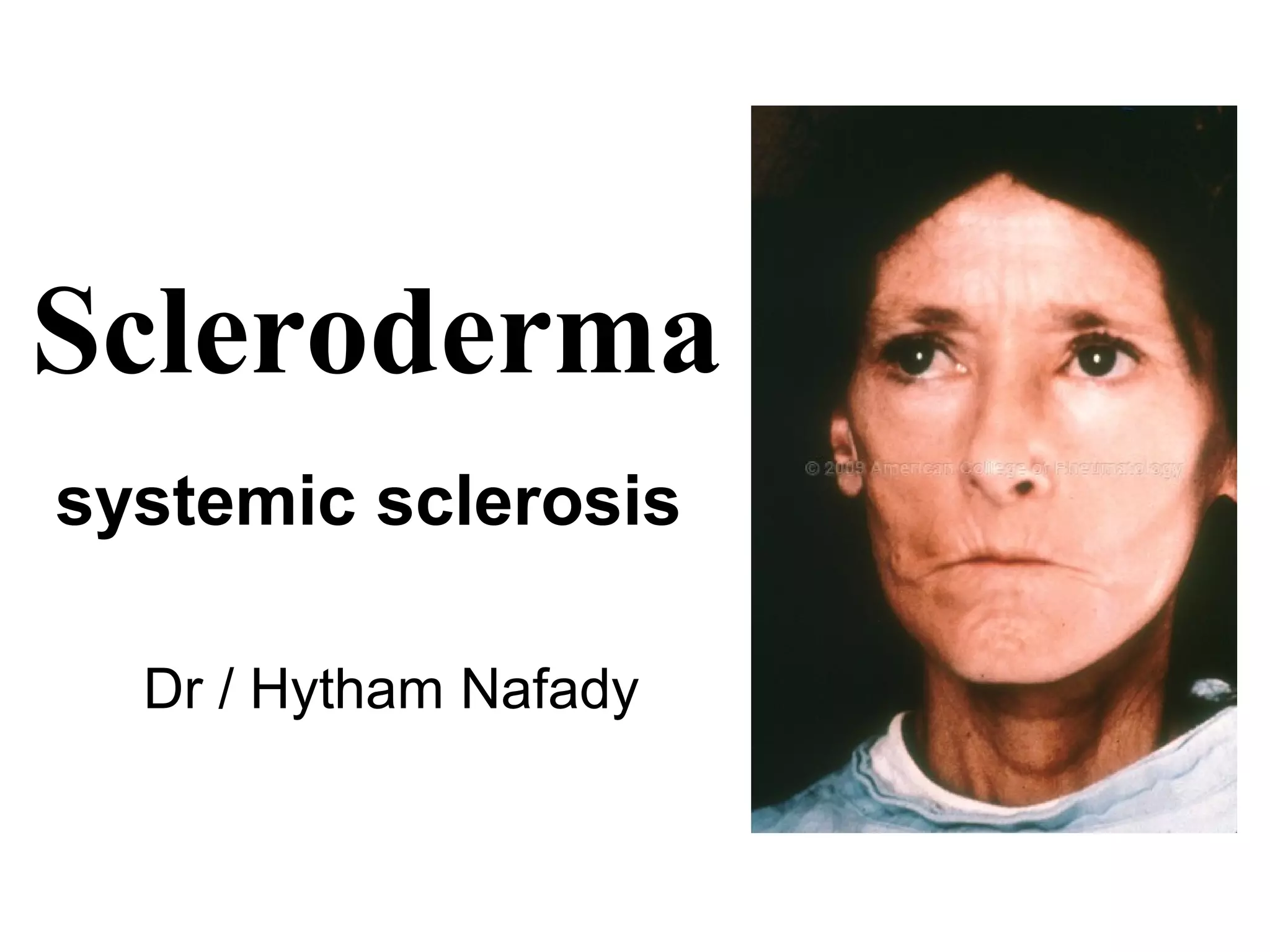Scleroderma | PPT