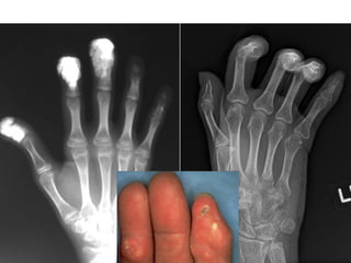 Scleroderma Hands Xray