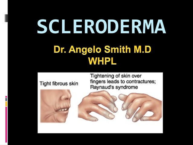 Scleroderma | PPT | Skin and Dermatology | Diseases and Conditions